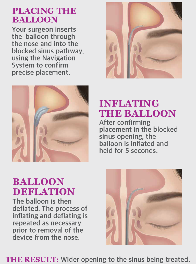 Balloon Sinuplasty My Sinus Doctor